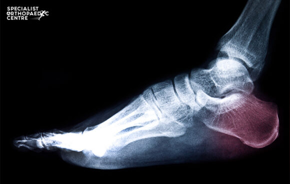 Understanding Bone Spurs And How To Treat Them | Specialist Orthopaedic ...